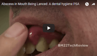 Abces op het tandvlees - dentalinfo.nl