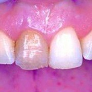 De verkleurde voortand: endodontische overwegingen - dentalinfo.nl