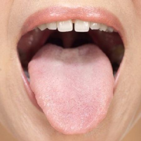 Nieuwe methode versneld hersteltijd na operatie keel- en mondkanker ...