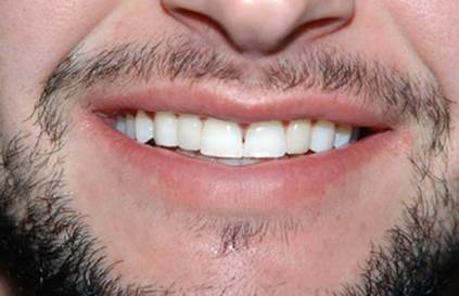 Casus Kerr: Esthetische indirecte restauratie met keramische facing ...