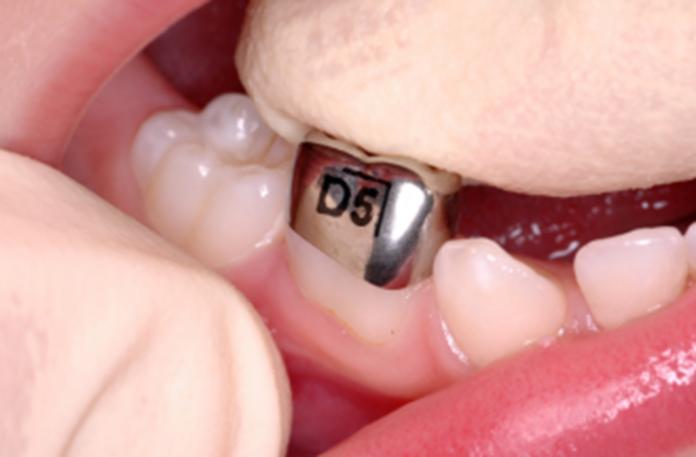 Kronen bij kinderen - dentalinfo.nl