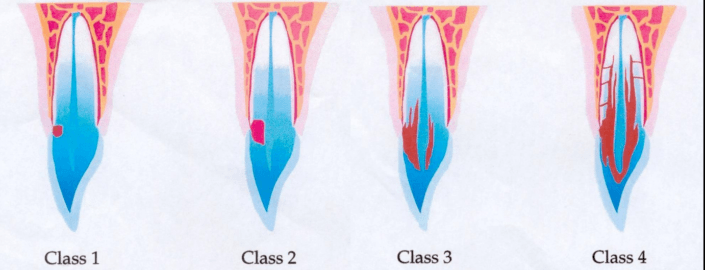Invasieve cervicale resorptie: Extractie of behoud? - dentalinfo.nl