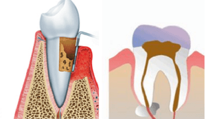 Paro-Endo of Endo-Paro: Hoe beide elkaar beïnvloeden - dentalinfo.nl