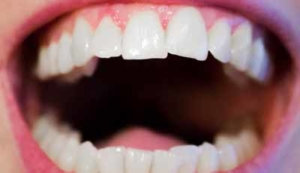 Richtlijn Klinische praktijkrichtlijn overkappingsprothese op ...