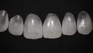 Casus: Non-prep facings, een non-invasive esthetische behandeling ...