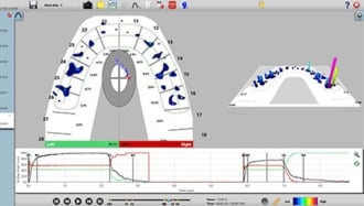 Occlusale hygiëne: de technische procedure van het inslijpen ...