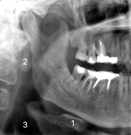 De panoramische röntgenopname - dentalinfo.nl