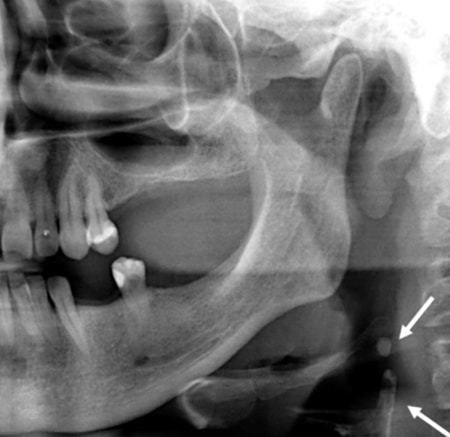 De panoramische röntgenopname - dentalinfo.nl