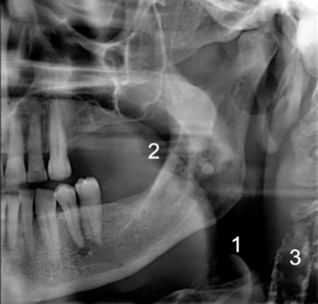 De panoramische röntgenopname - dentalinfo.nl