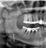 De panoramische röntgenopname - dentalinfo.nl