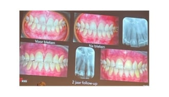 Minimaal invasieve endodontie, wanneer en hoe? - dentalinfo.nl